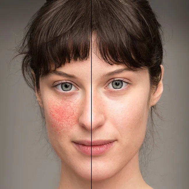 Les 5 meilleurs traitements naturels contre la rosacée | ShytoBuy