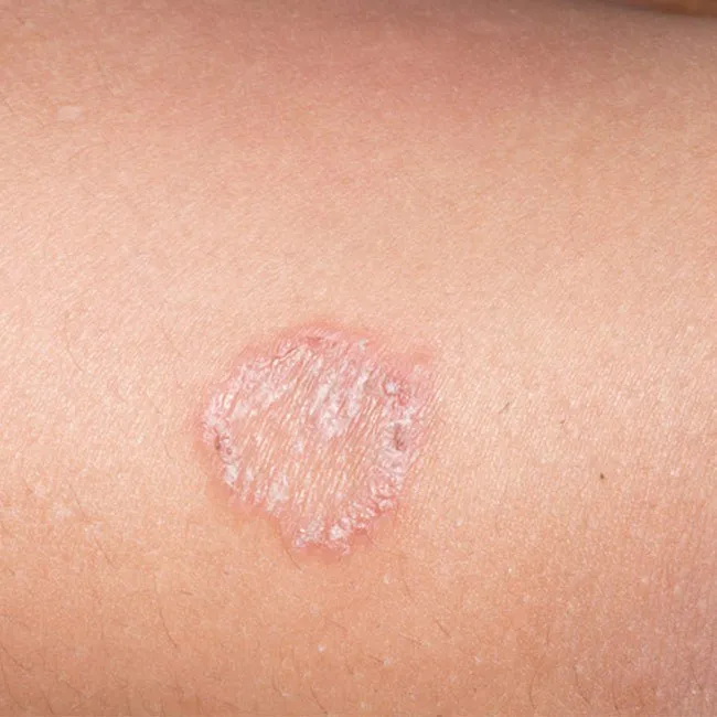 Teigne Désinfection Maison | Ventana Blog